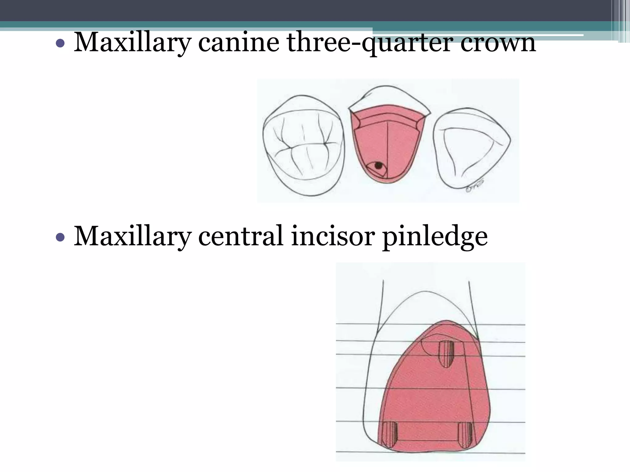 Tooth preparation for partial veneer crwns | PPTX
