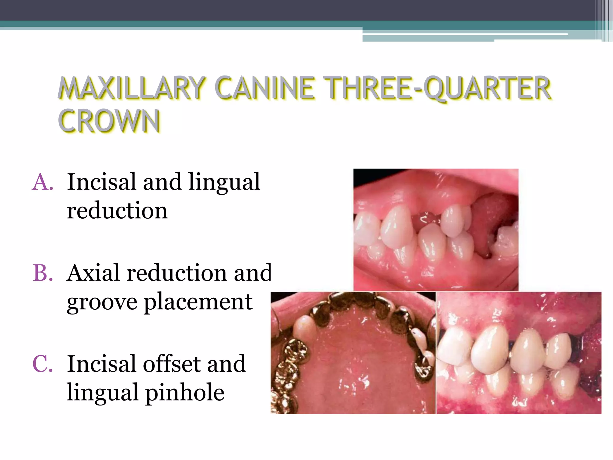 Tooth preparation for partial veneer crwns | PPTX