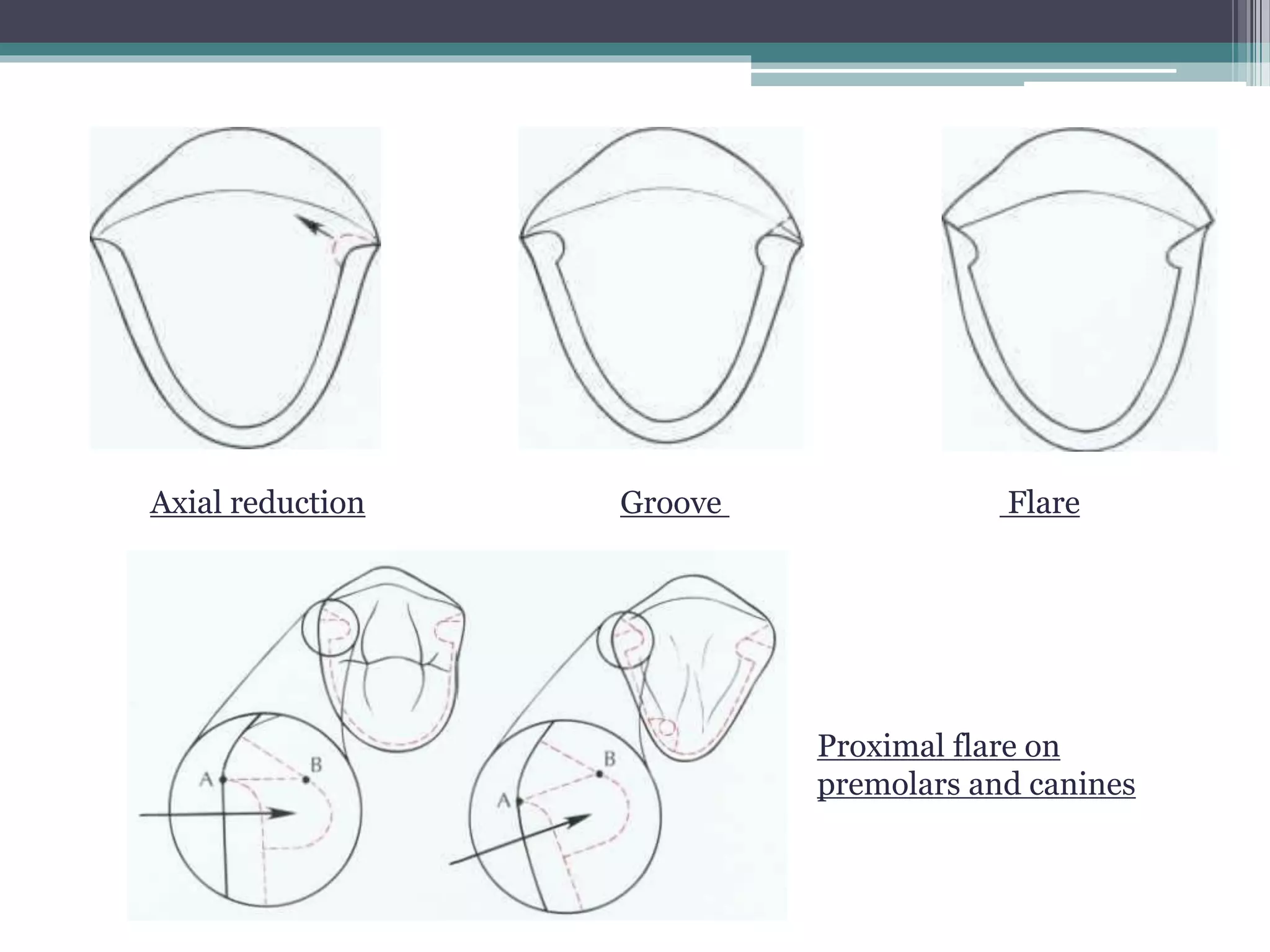 Tooth preparation for partial veneer crwns | PPTX