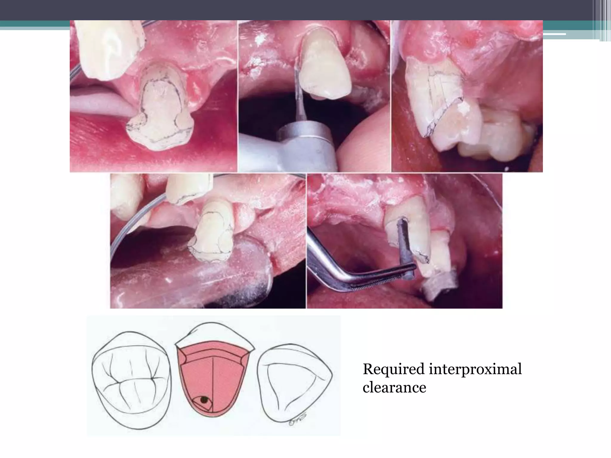 Tooth preparation for partial veneer crwns | PPTX