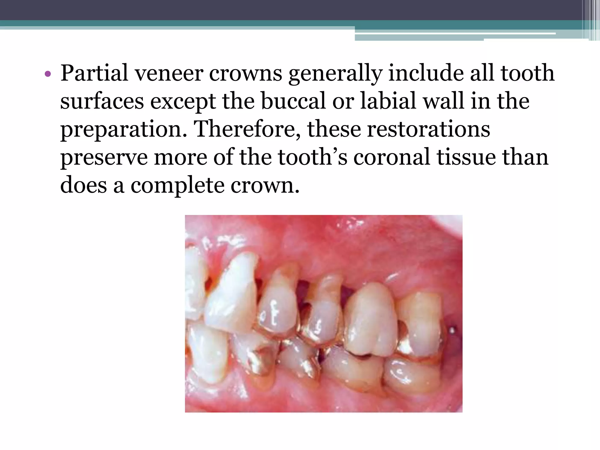 Tooth preparation for partial veneer crwns | PPTX