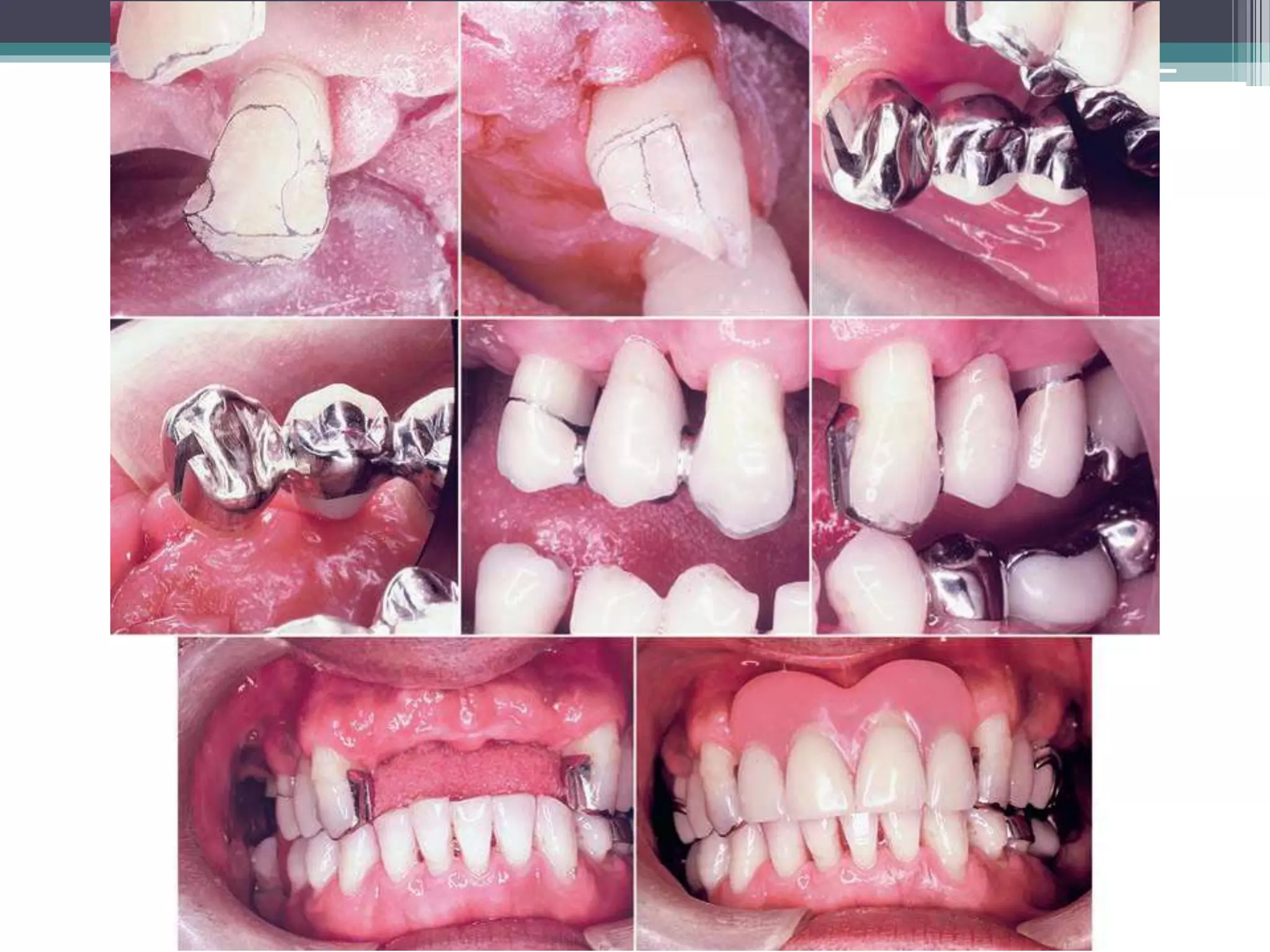 Tooth preparation for partial veneer crwns | PPTX