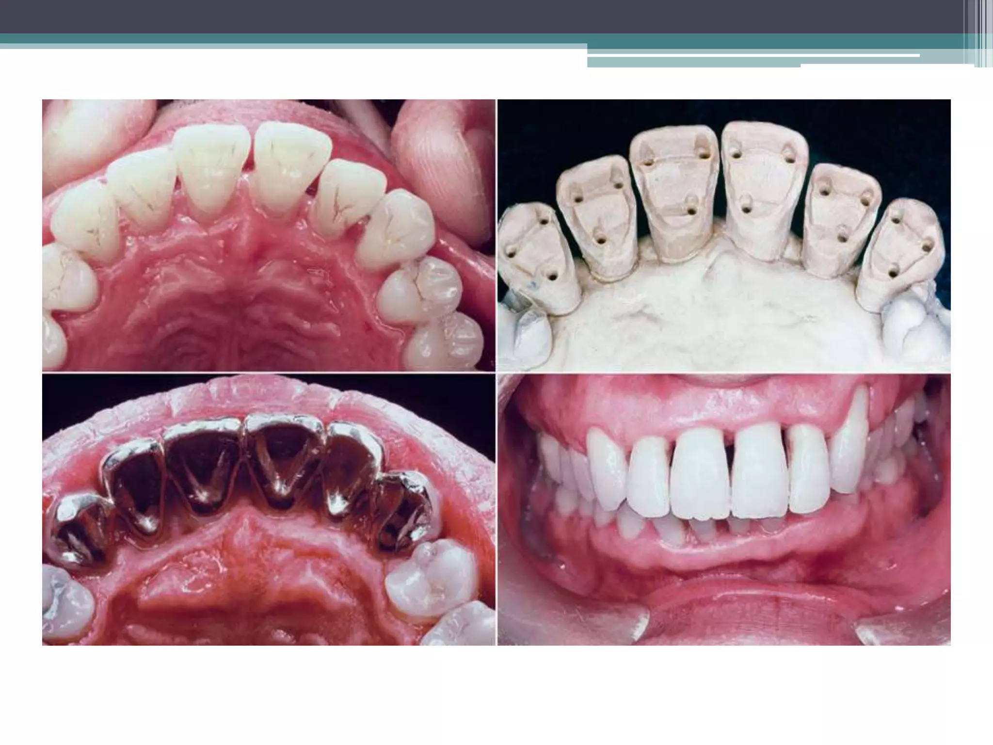 Tooth preparation for partial veneer crwns | PPTX