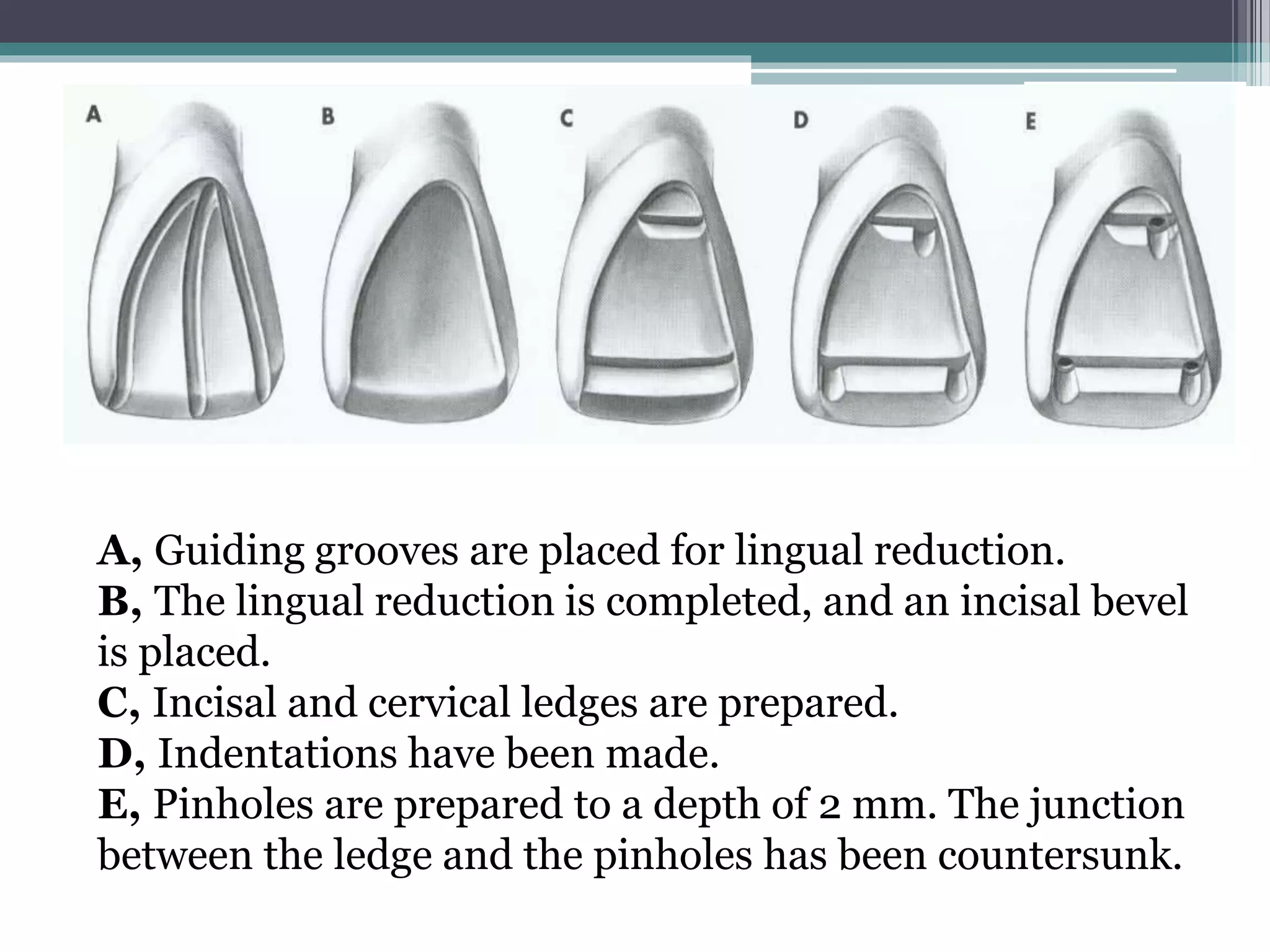 Tooth preparation for partial veneer crwns | PPTX