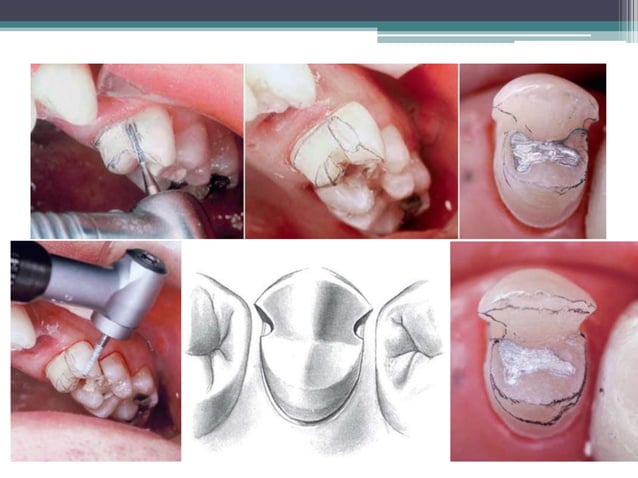 Tooth preparation for partial veneer crwns | PPTX | Dental Health ...