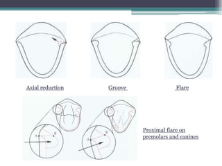 Tooth preparation for partial veneer crwns | PPTX