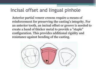 Tooth preparation for partial veneer crwns | PPTX