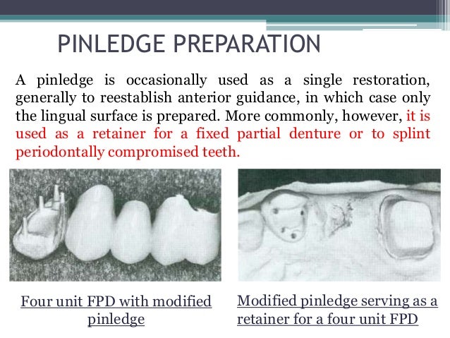 Tooth preparation for partial veneer crwns