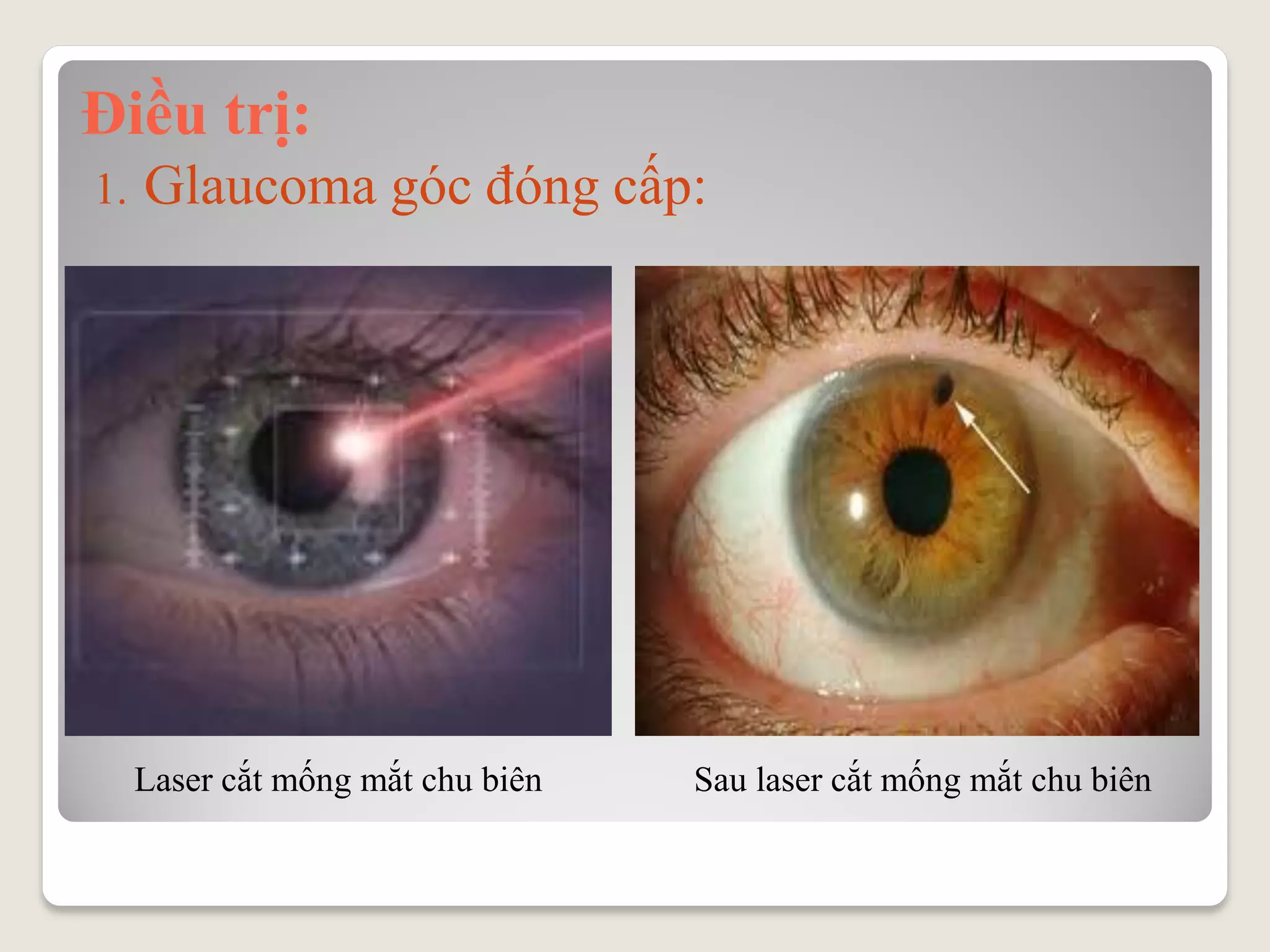 BỆNH GLAUCOMA | PDF