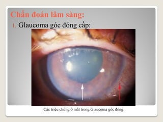 BỆNH GLAUCOMA | PDF