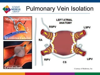 All You Need to Know About Atrial Fibrillation | PPT