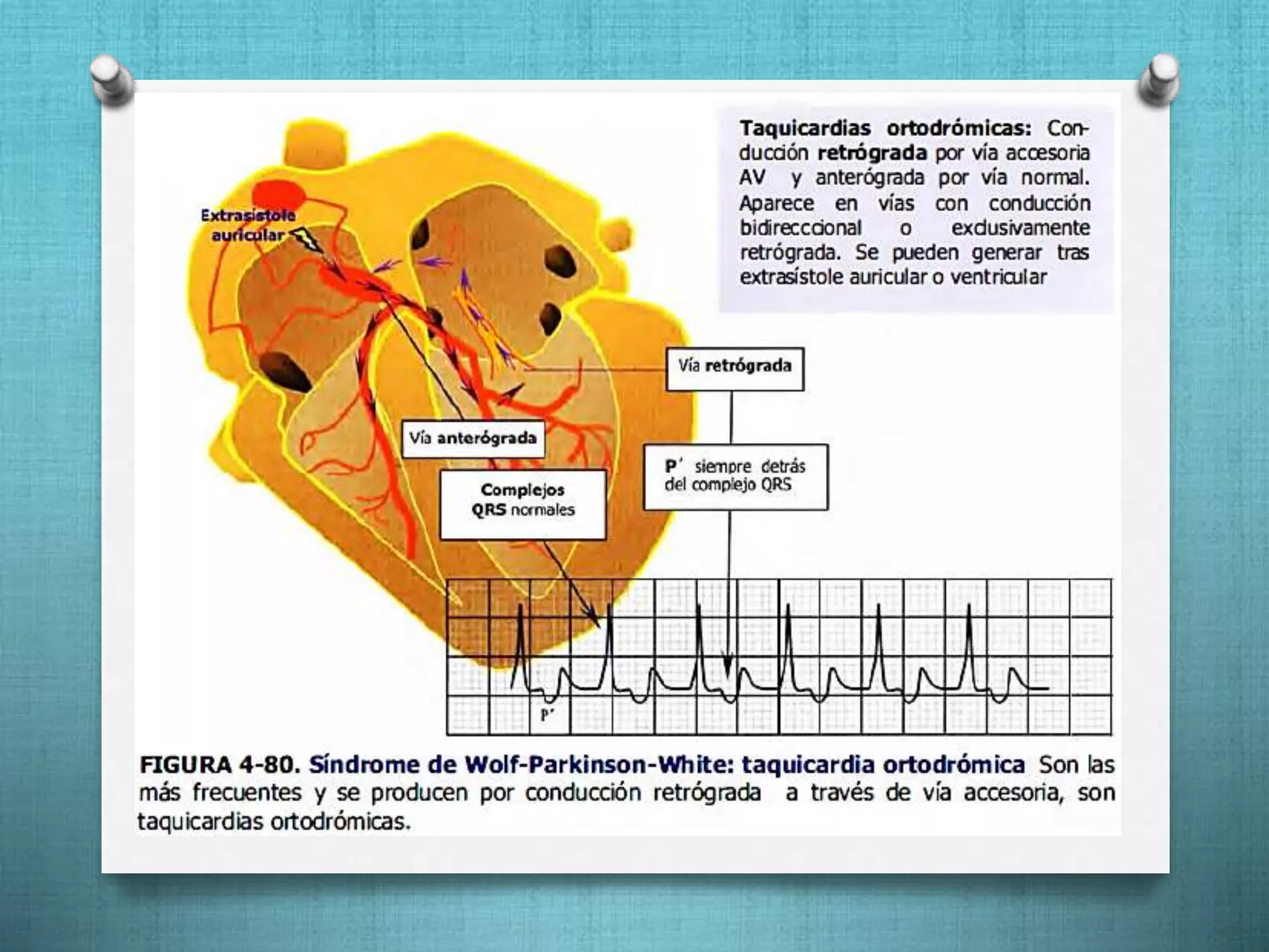 Sindrome de preexitacion | PPTX
