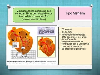 Sindrome de preexitacion | PPTX