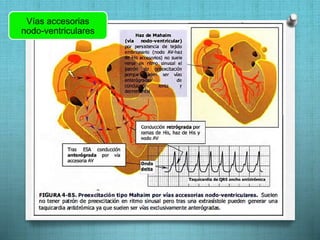 Sindrome de preexitacion | PPTX