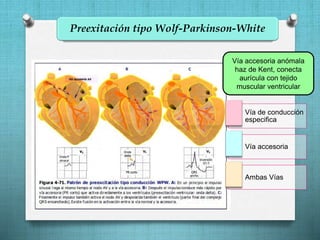 Sindrome de preexitacion | PPTX