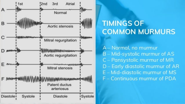 Cardiology 1.6. Heart Sounds and Murmurs - by Dr. Farjad Ikram