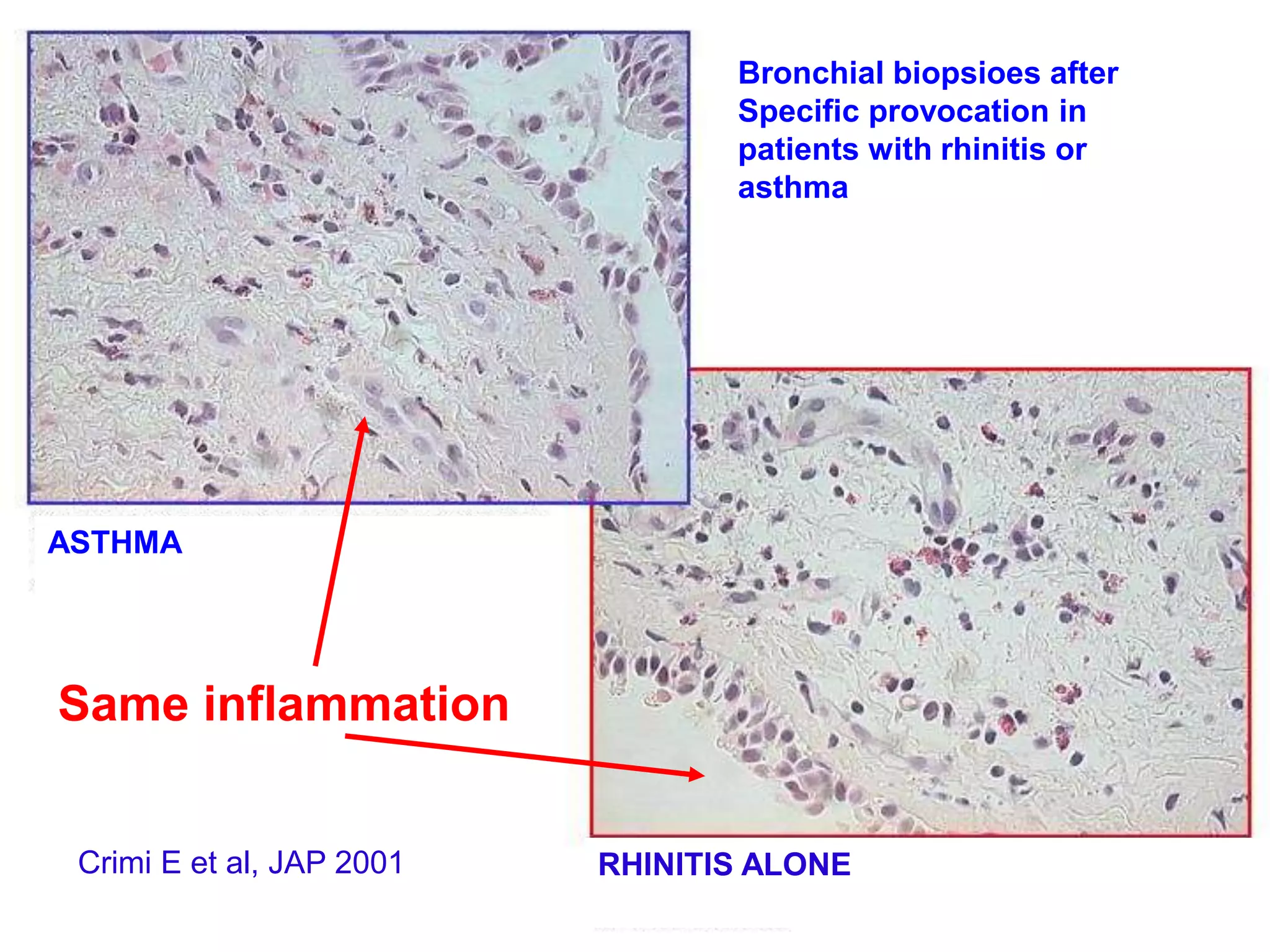 Insights in Asthma Rhinitis link | PPTX