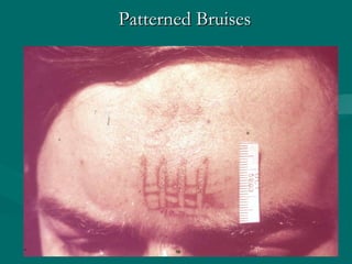 Bases of Forensic medical traumatology. Blunt objects | PPT