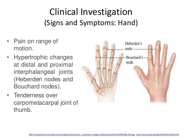 Heberden's Nodes Symptoms
