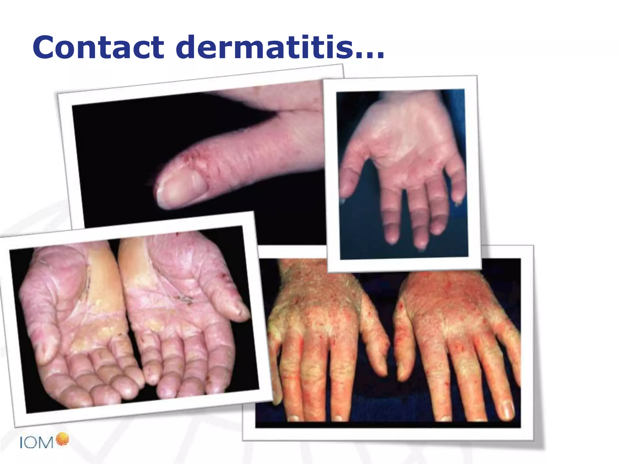 Why is dermal exposure important? | PPTX