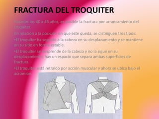 1.luxacion escapulohumeral (1) | PPTX