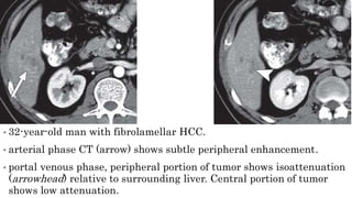 patterns of enhancement in hepatocellular carcinoma | PPTX