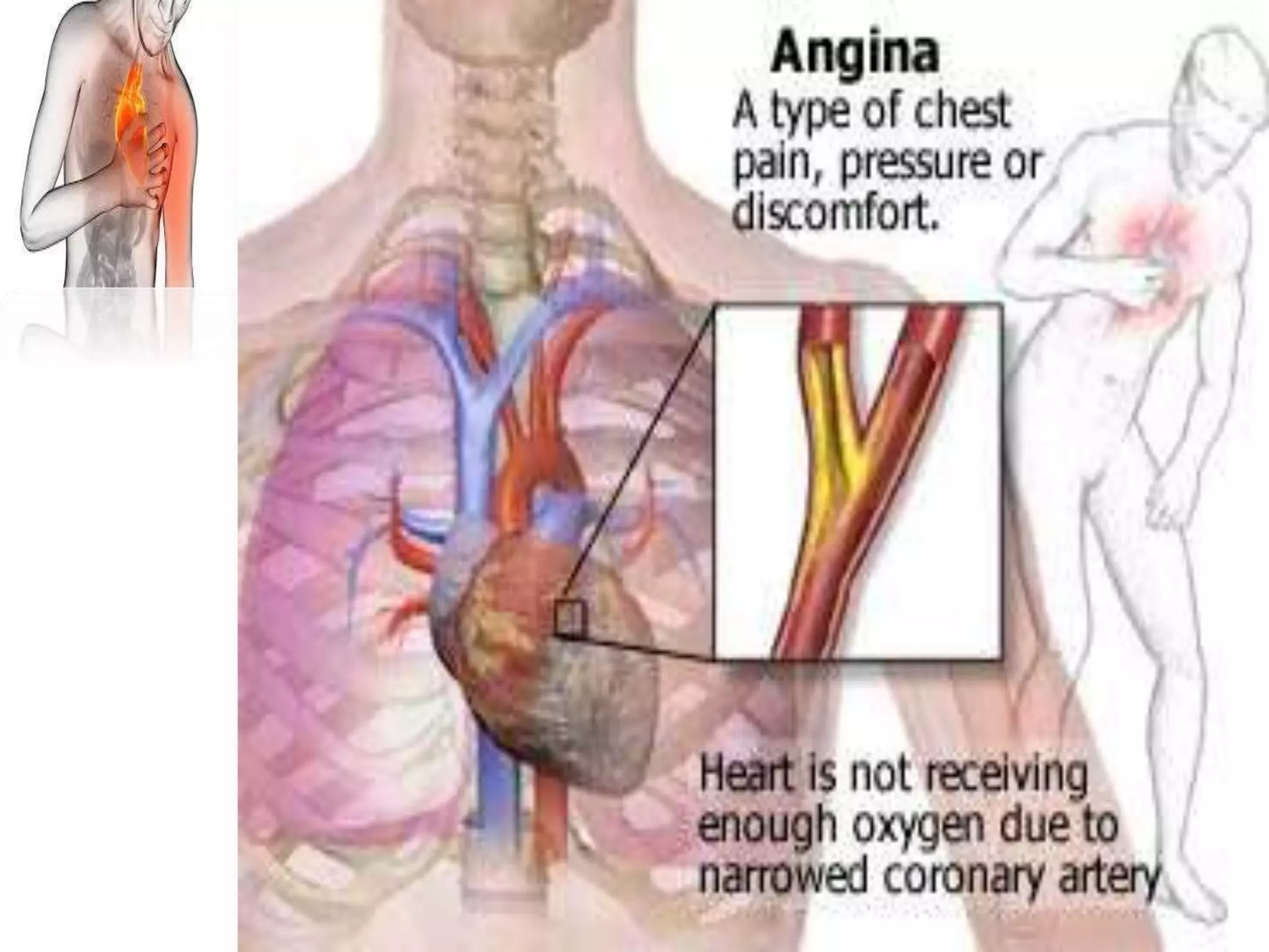 ANGINA: patofisiologi angina dan gagal jantung-Ischemia of heart muscle of angina and heart ...