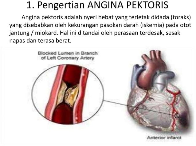 ANGINA: patofisiologi angina dan gagal jantung-Ischemia of heart muscle ...