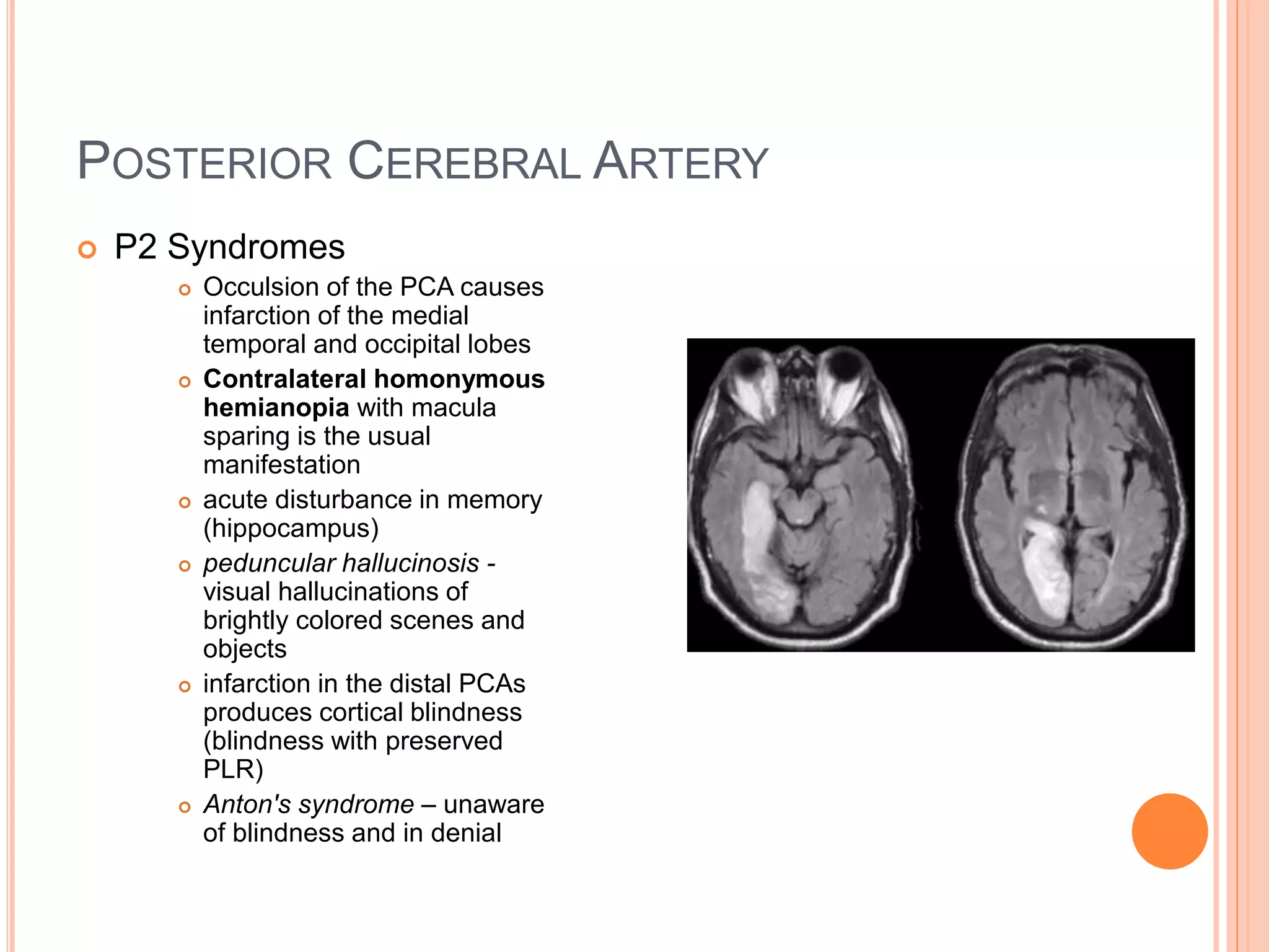 1.stroke epidemiology and stroke syndromes dr trilochan shrivastava | PPTX
