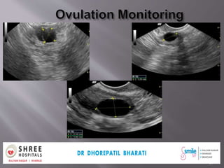 Ovarian Physiology - Clinical Perspective - Dr Dhorepatil Bharati | PPTX