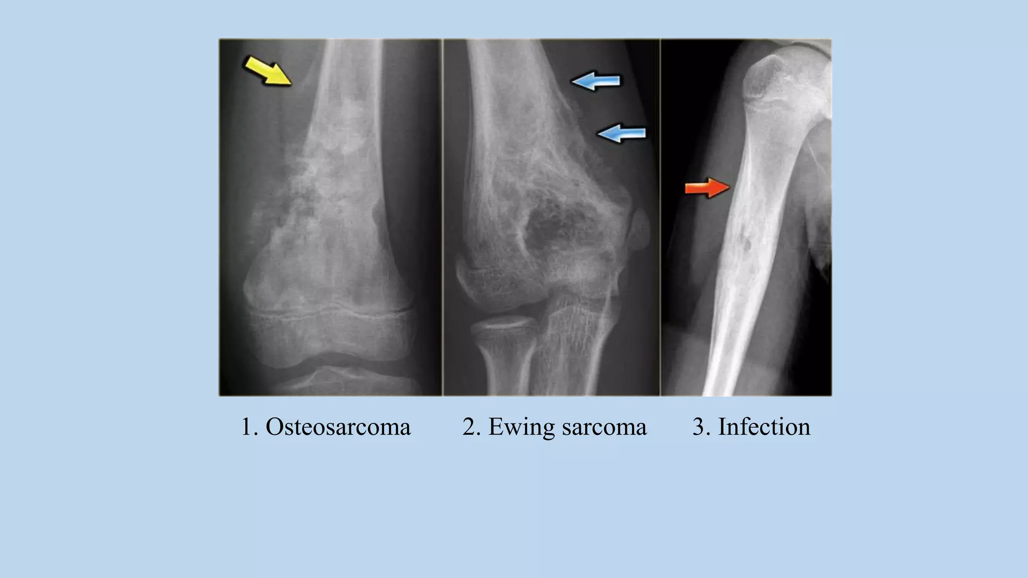 Radiological Approach To Bone Tumours | PPTX