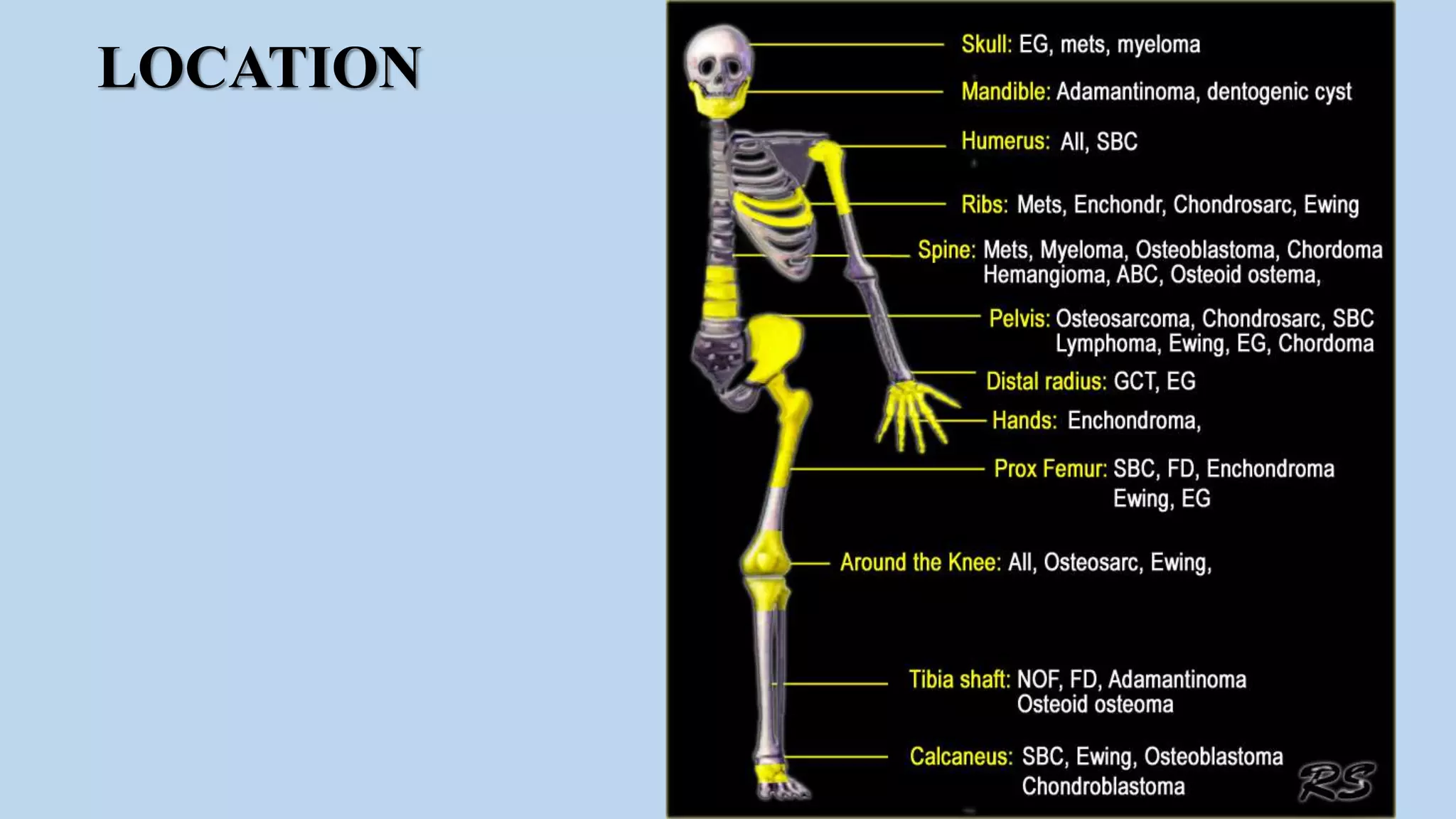Radiological Approach To Bone Tumours | PPTX