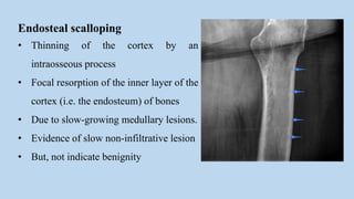 Radiological Approach To Bone Tumours | PPT