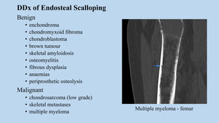 Radiological Approach To Bone Tumours | PPT