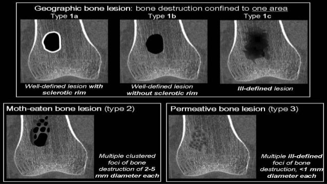 Radiological Approach To Bone Tumours