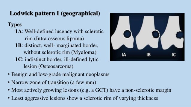 Radiological Approach To Bone Tumours
