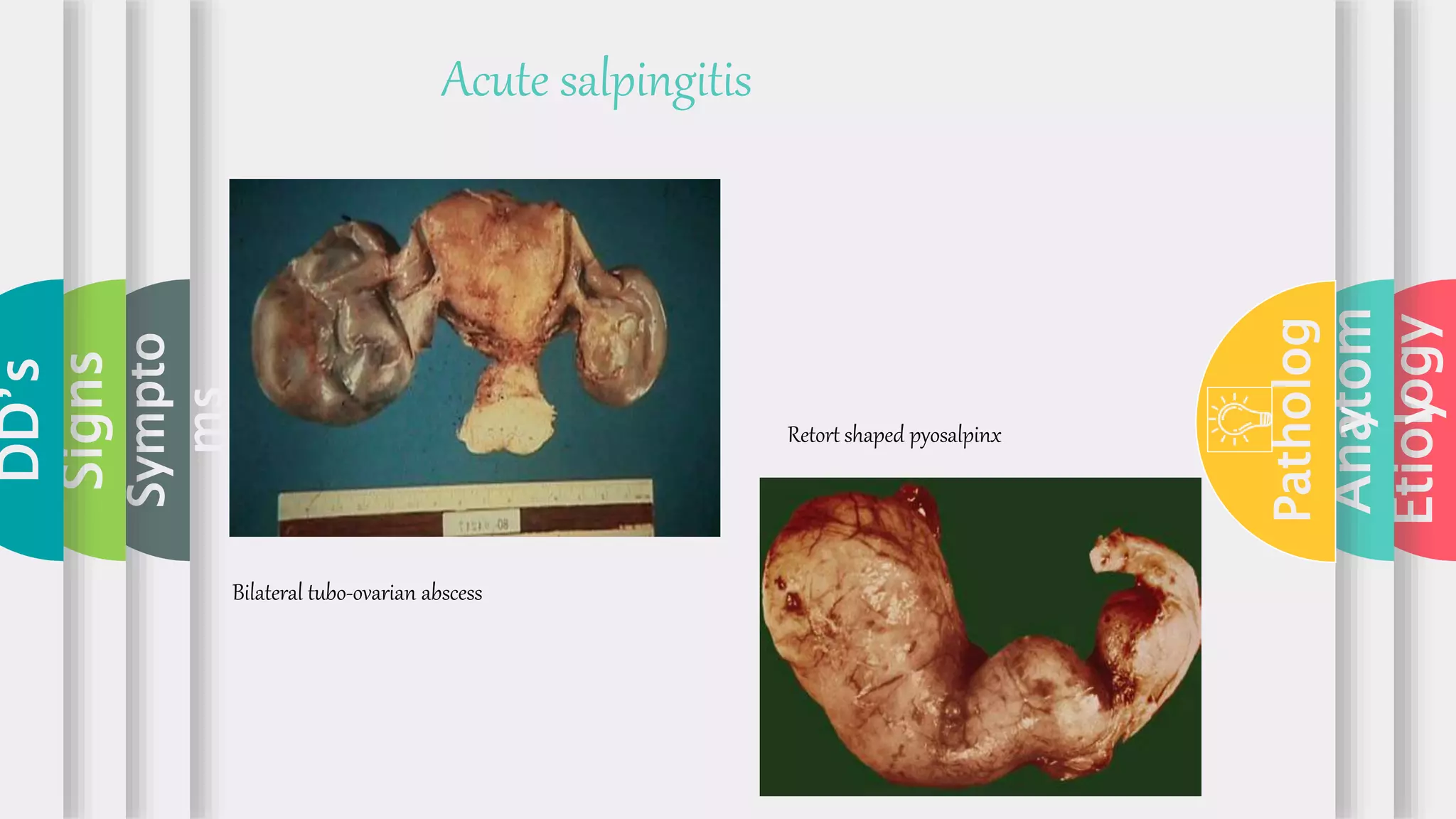 Pelvic Inflammatory Disease | PPTX