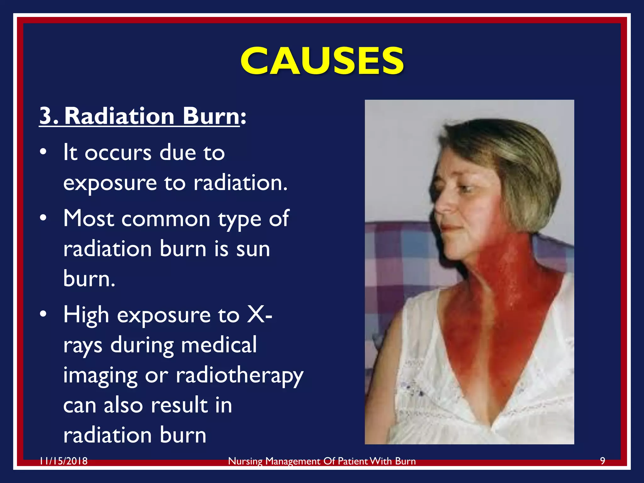1. burn cne ppt | PDF