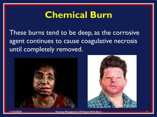 1. burn cne ppt | PDF