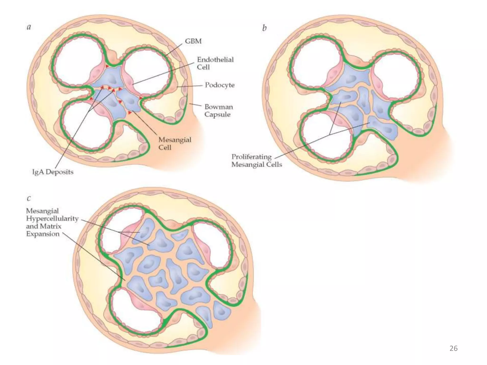 case presentation on CKD | PPTX