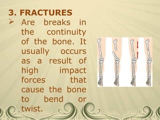 Sports Injuries (Grade 11 PE and HEALTH) | PPT