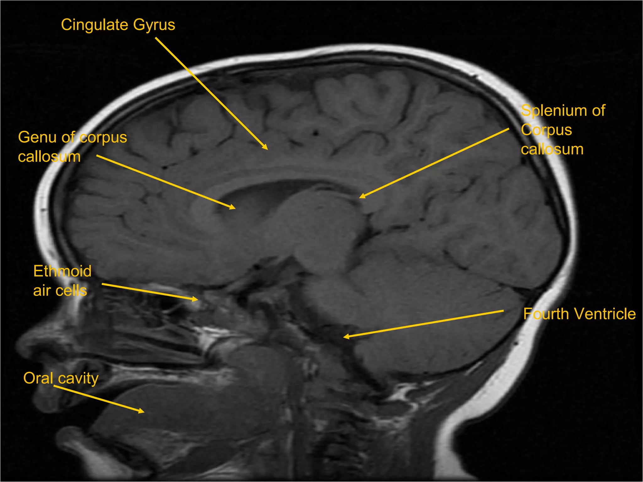 Radiological anatomy of the brain | PPT