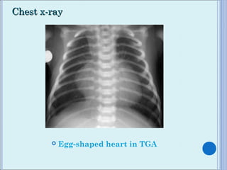 Congenital cyanotic Heart Disease -Dr.Wahid Helmi ., Pediatric ...