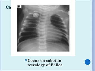 Congenital cyanotic Heart Disease -Dr.Wahid Helmi ., Pediatric ...