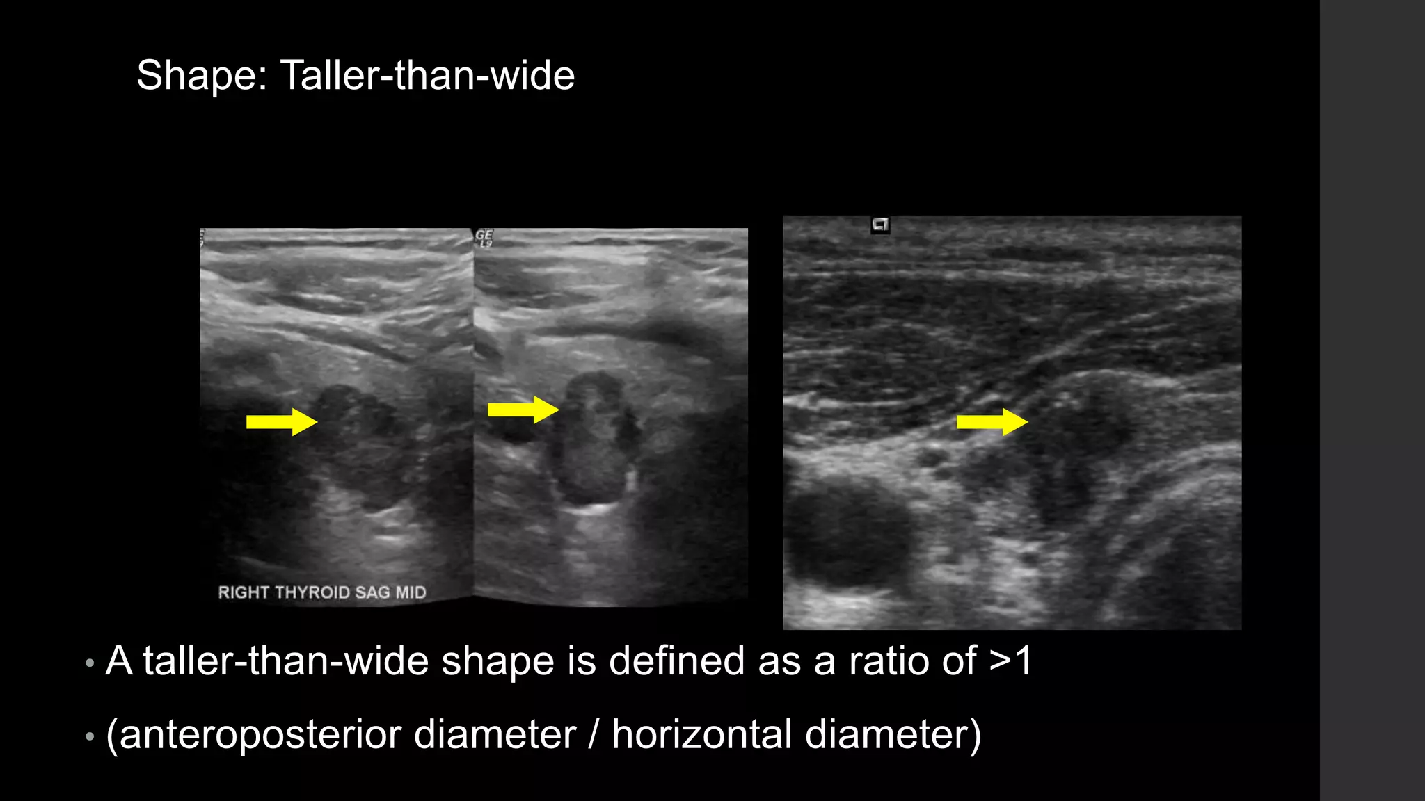 Thyroid Imaging Reporting And Data System Ppt