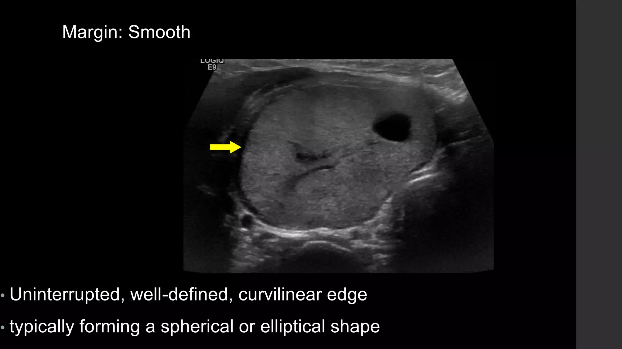 Thyroid Imaging Reporting And Data System Pptx