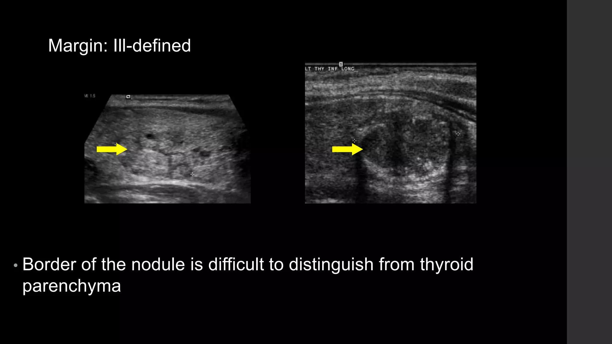 Thyroid Imaging Reporting And Data System Pptx