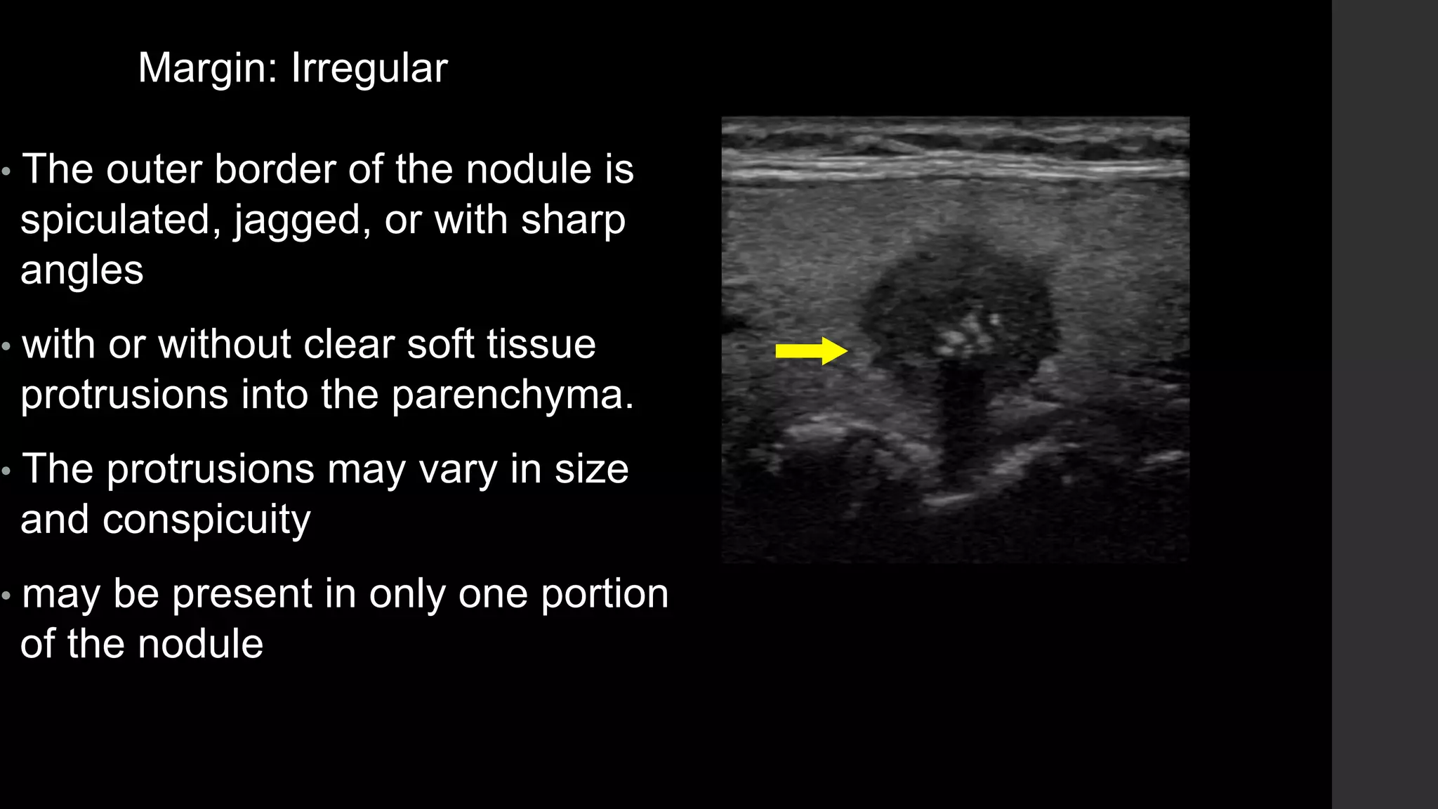 thyroid imaging reporting & data system | PPTX