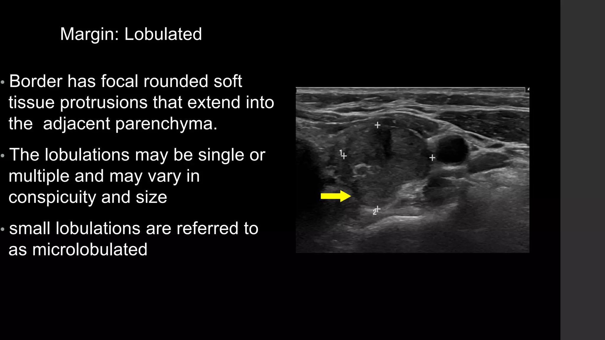thyroid imaging reporting & data system | PPTX