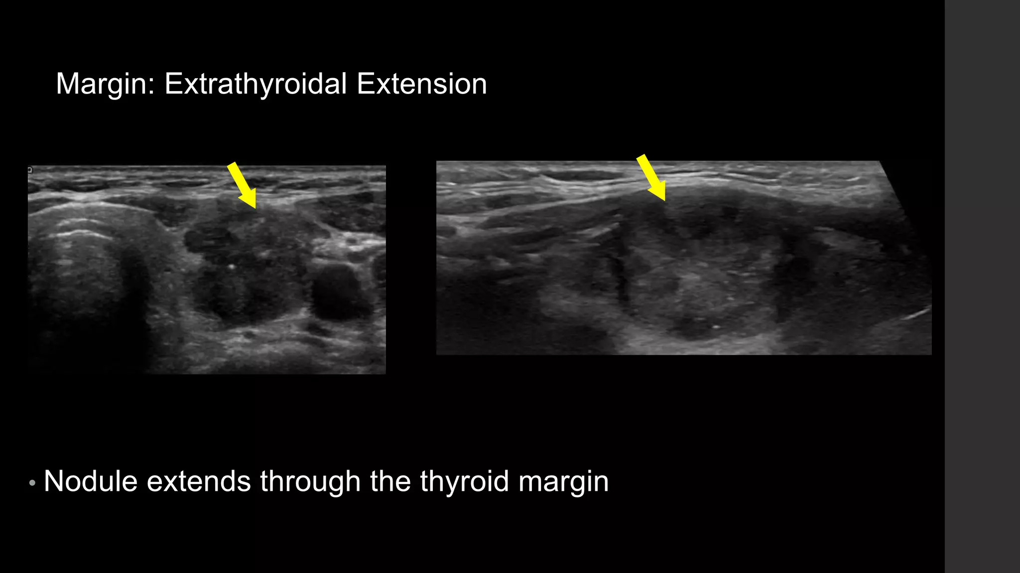 thyroid imaging reporting & data system | PPTX